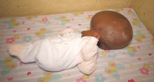 (Video) Swollen Head Baby with the heartbreaking condition