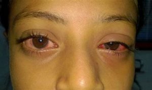 Apollo Eye Infection: Causes, Effects, Prevention, and Treatment ...